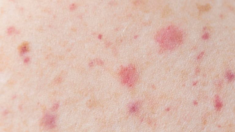 Culebrilla: así se contagia y estos son los síntomas