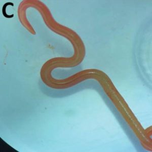 Extraen lombriz intestinal viva del cerebro de mujer - Noticias de El ...