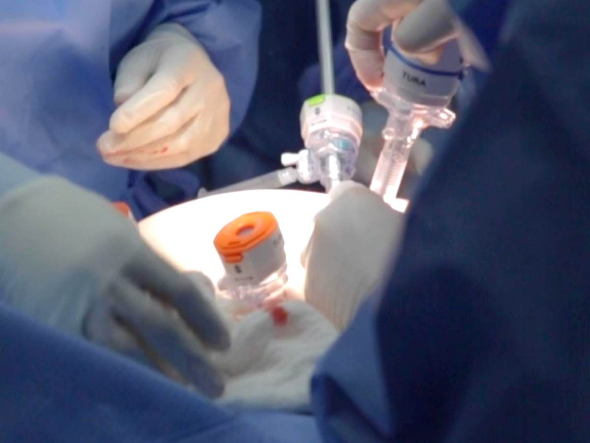 Cómo acceder a una cirugía de manga gástrica en el ISSS